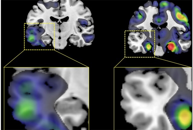 Brain scans suggest subtypes of Alzheimer’s disease - UW Medicine ...