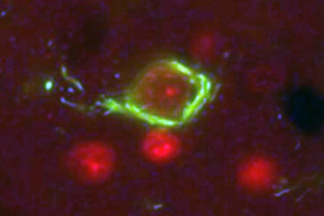 Targeting tau, the other protein behind Alzheimer's disease - UW ...