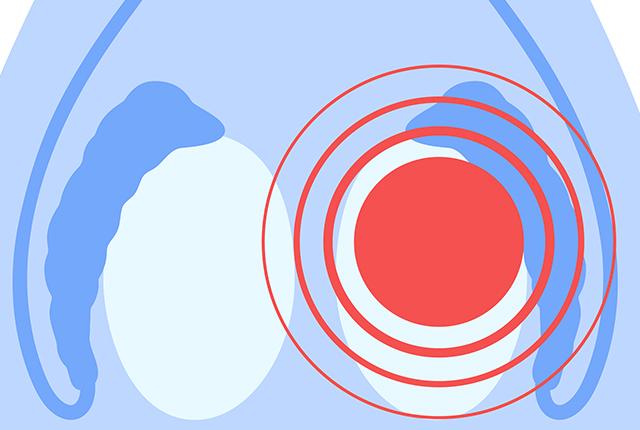 Early detection is best guard against testicular cancer - UW Medicine ...
