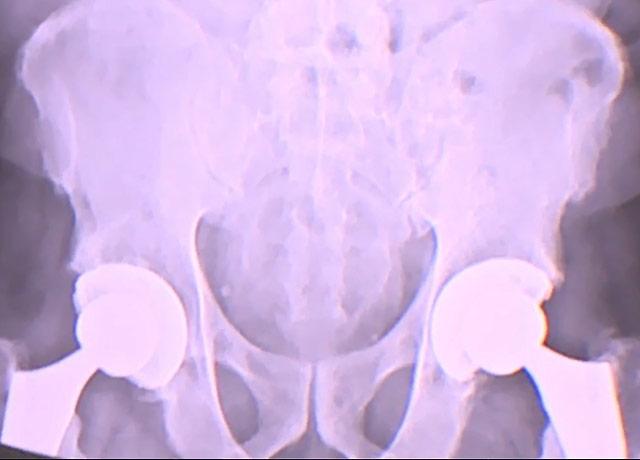 Segment: Artificial hips, but a real zeal for activity - UW Medicine ...