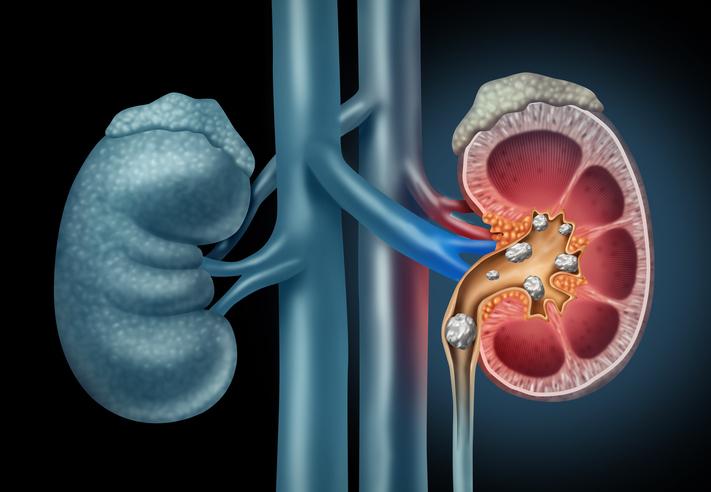 How to get rid of kidney stones naturally store
